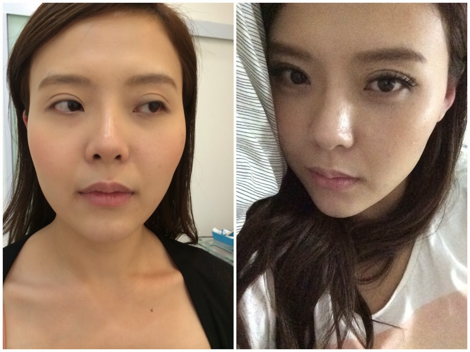 Live A Life You Will Remember : V Shaped Face - Botox and Fillers